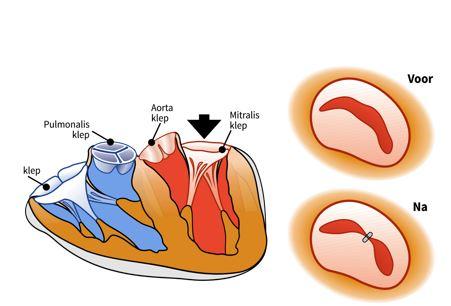Mitralisklepreparatie met MitraClip via een bloedvat in de lies ...