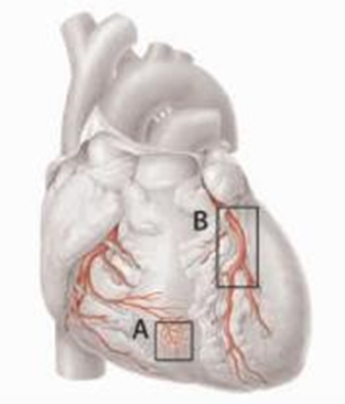 Pijn op de borst zonder duidelijke vernauwingen van de kransslagaders