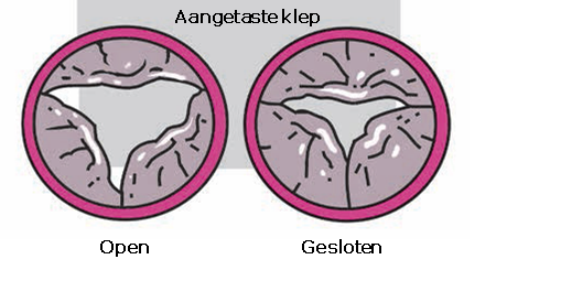 Hartklepaandoeningen