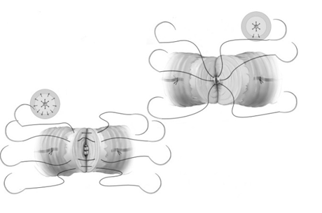 Hersteloperatie na sterilisatie van de man