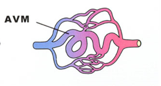 AVM (Arterio-Veneuze Malformatie, vaatmalformatie)