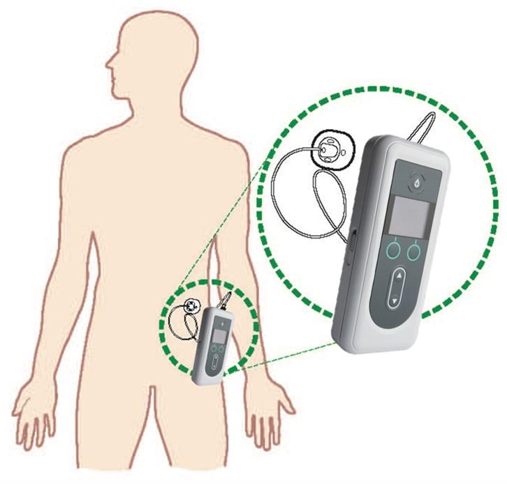 Continue Subcutane Levodopa Infusie (CSLI) behandeling bij de ziekte ...
