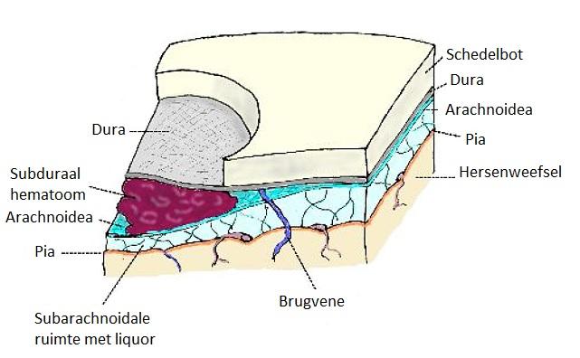 Chronisch subduraal hematoom