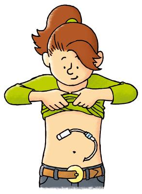 Buikdialyse, wat is dat? Informatie voor kinderen