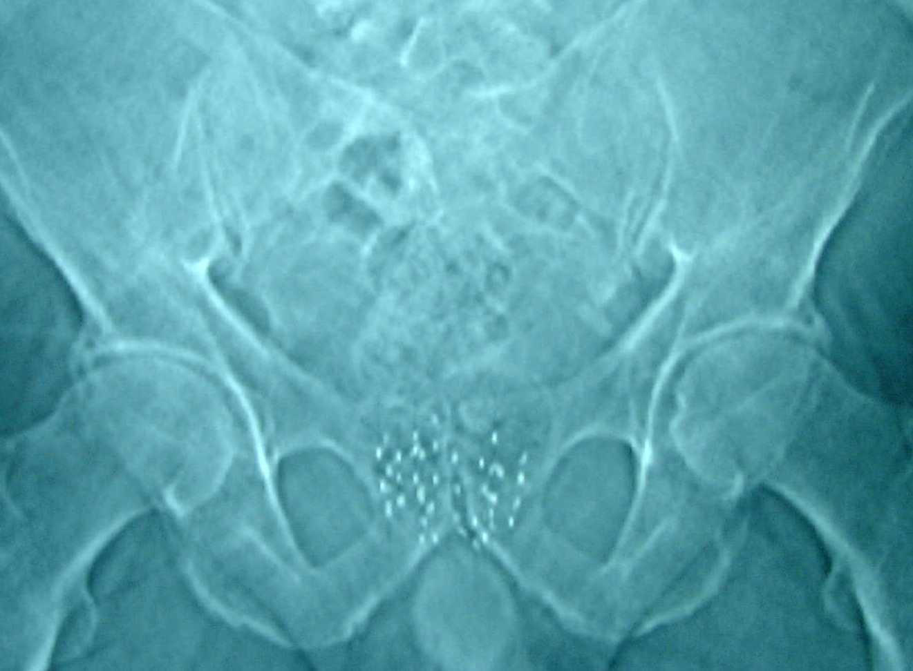 Prostaatkanker en inwendige bestraling met I-125 zaadjes