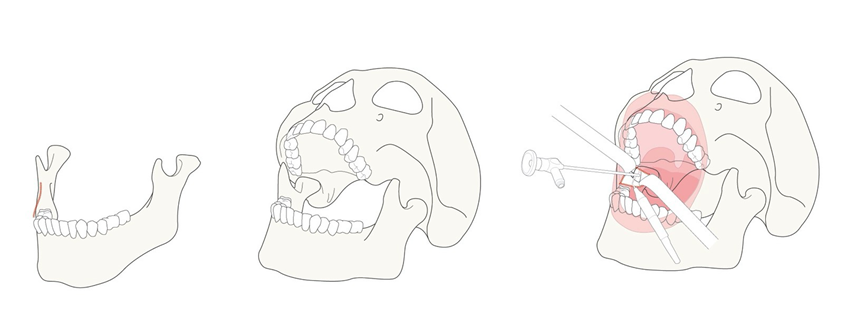 Unilaterale Condylaire Hyperplasie (UCH)
