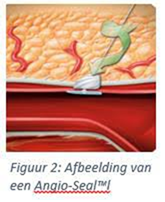 Angioseal