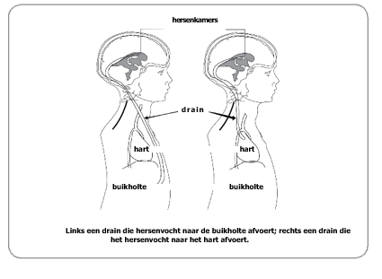 Waterhoofd (hydrocefalus) | Amsterdam UMC