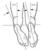 In-toeing, naar binnen staande voeten bij kinderen | Amsterdam UMC