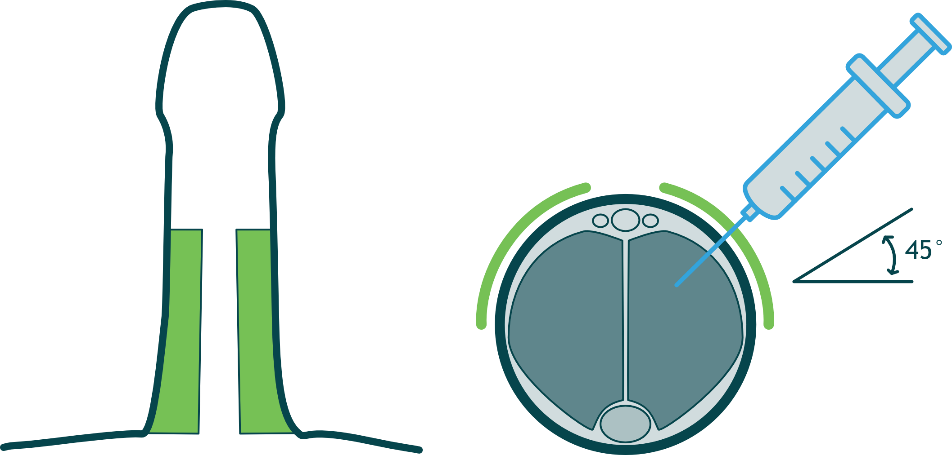 Androskat injectietherapie