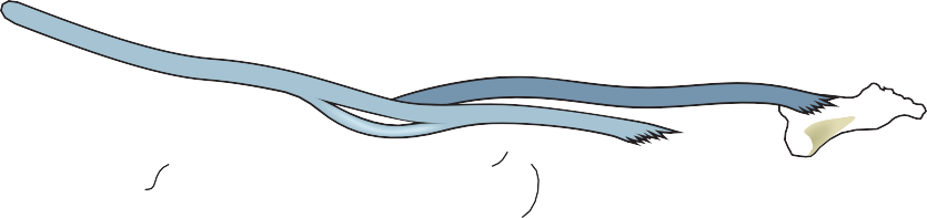 Buigpeesletsel van de hand; behandeling na de operatie | Amsterdam UMC