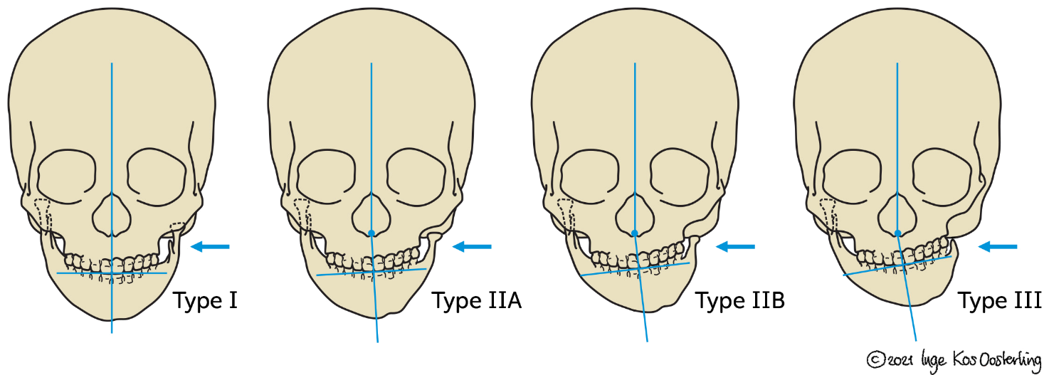 Craniofaciale microsomie