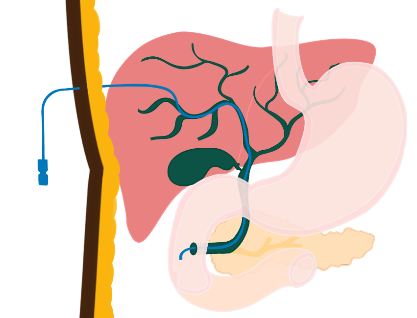 ERCP of EUS-geleide galwegdrainage