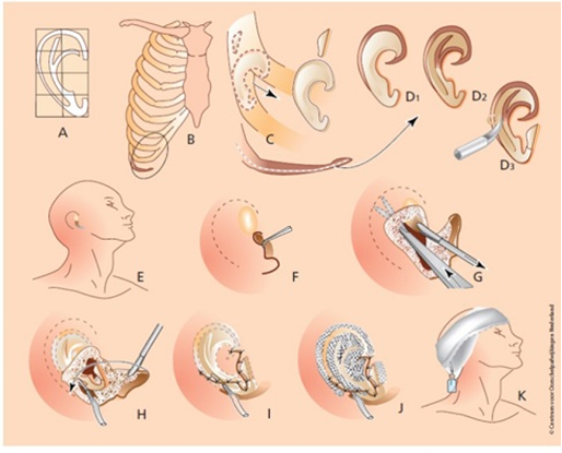Oorschelpcorrectie (microtie)