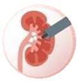 Endoscopic combined intrarenal surgery (ECIRS) | Amsterdam UMC