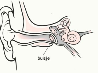Vocht achter het trommelvlies; Otitis Media met Effusie (OME), Trommel ...