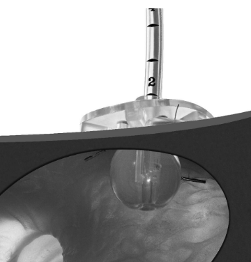 PEG-sonde endoscopische plaatsing bij kinderen; PUSH methode
