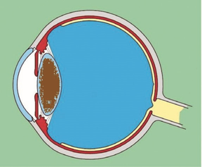 Staar (cataract en staaroperatie bij volwassenen)