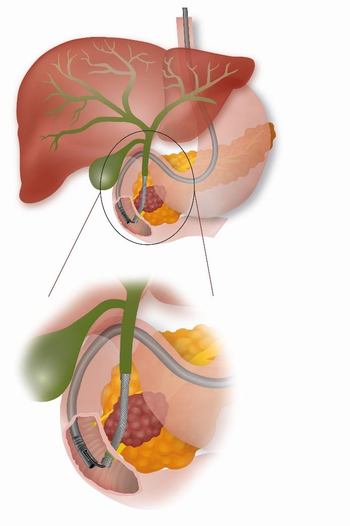 ERCP of EUS-geleide galwegdrainage