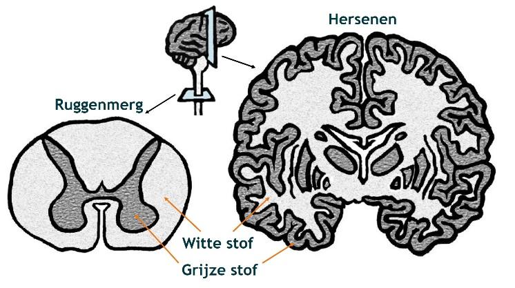 Metachromatische leukodystrofie - patiëntinformatie