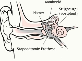 Ooroperatie bij otosclerose; vervanging van de stijgbeugel