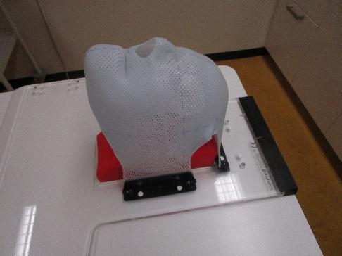 Bestraling bij een meningeoom (radiotherapie)