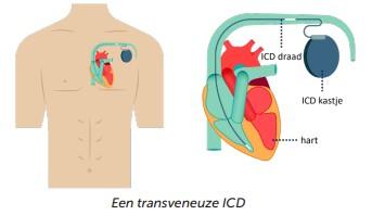 ICD (Implanteerbare Cardioverter Defibrillator)