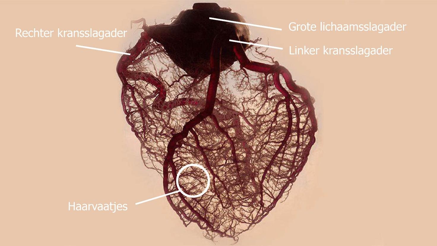 Myocard-bruggen (Myocardiale Bridging)