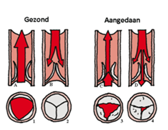 Transkatheter aortaklepimplantatie, Transkatheter Aortic Valve ...