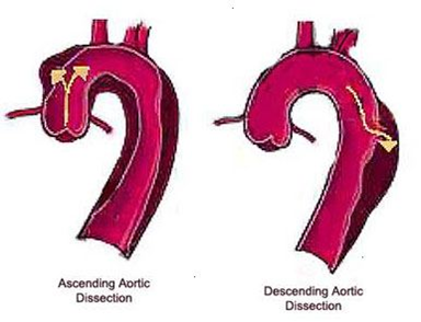 Aorta aneurysma en dissectie - patiëntinformatie