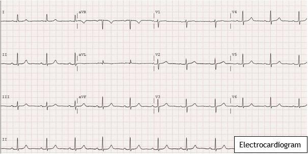 Diastolisch hartfalen “een stijf hart”