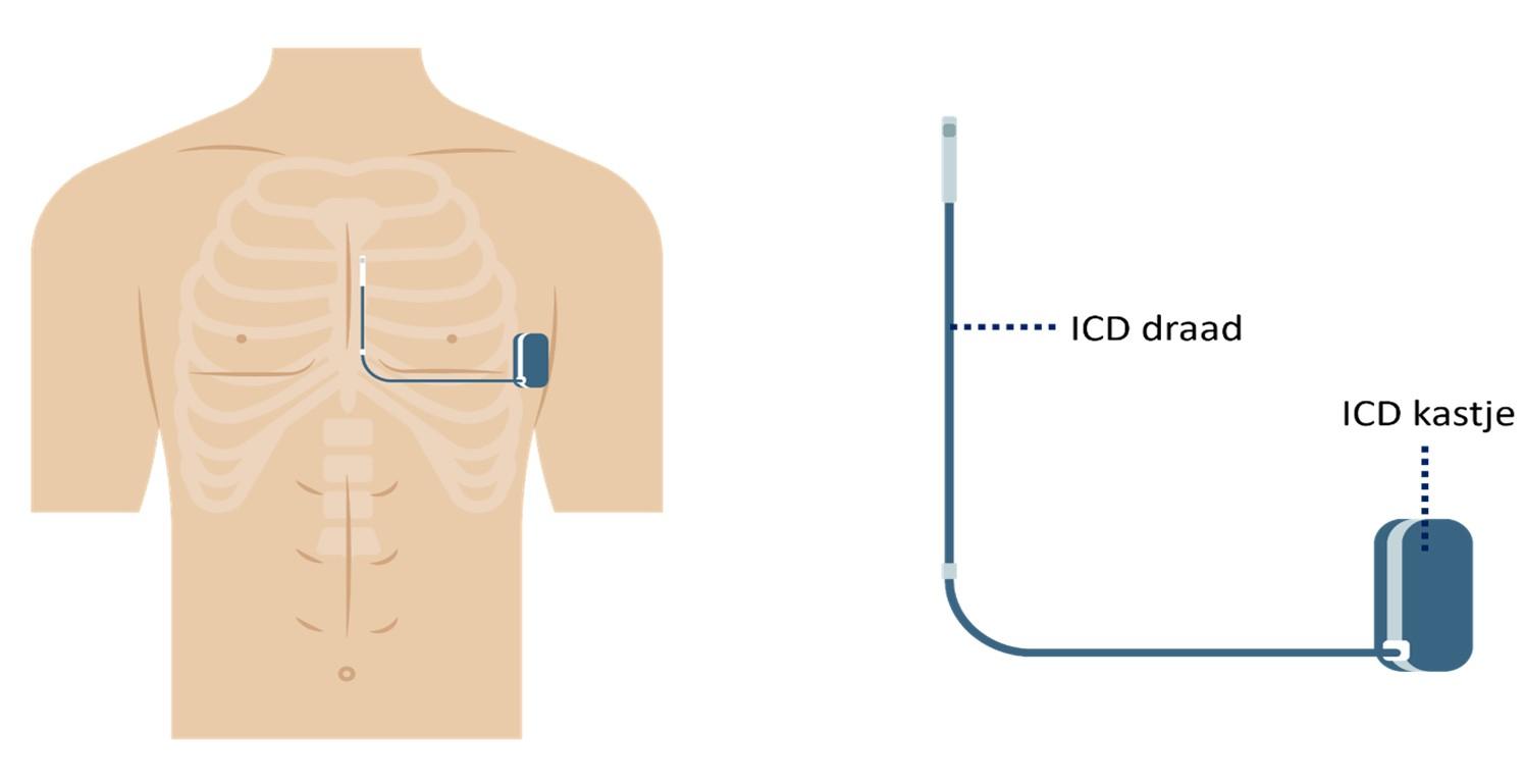 S-ICD (Subcutane Implanteerbare Cardioverter Defibrillator) | Amsterdam UMC