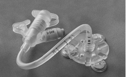 PEG-sonde endoscopische plaatsing bij kinderen; PUSH methode