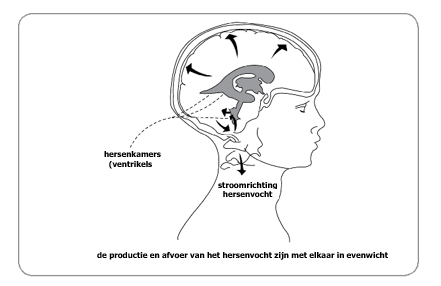 Waterhoofd (hydrocefalus) | Amsterdam UMC