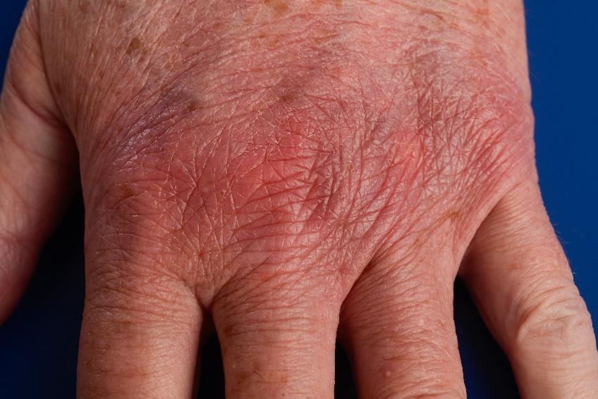 Lymeziekte (Lyme borreliose)