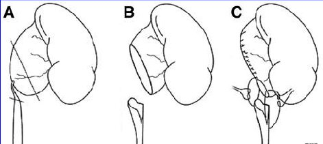 Onderzoeken bij een verwijd nierbekken