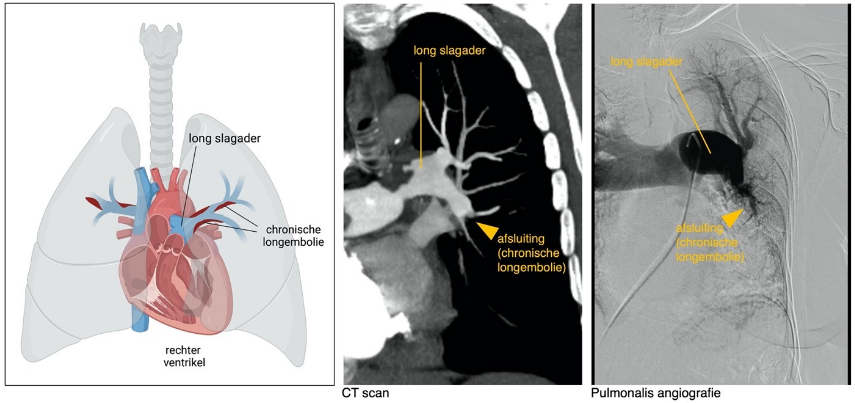 Chronische Thrombo-embolische Pulmonale Hypertensie (CTEPH); algemene ...