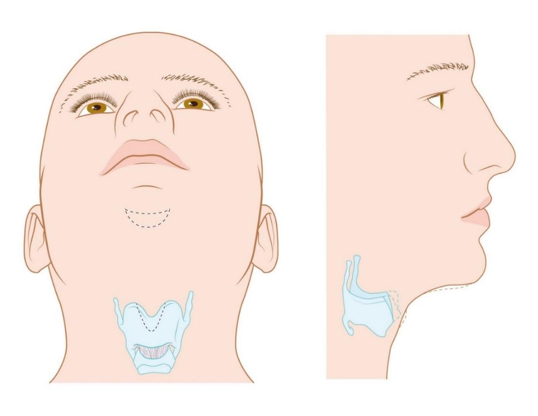 Feminiserende gelaatschirurgie (soorten operaties)