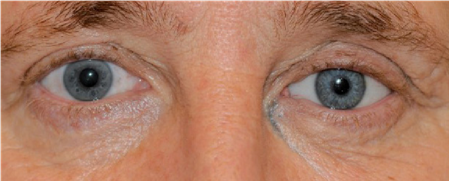 Operatieve oogverwijdering, enucleatie/evisceratie