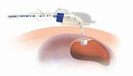 Met een PEG-sonde naar huis