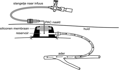Port-A-Cath (PAC) bij uw kind; informatie voor ouders