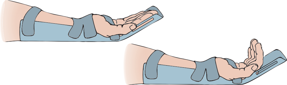 Buigpeesletsel, oefeningen en instructies eerste periode