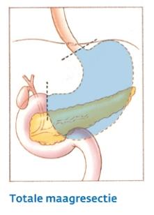 Voedingsadviezen na een totale maagresectie