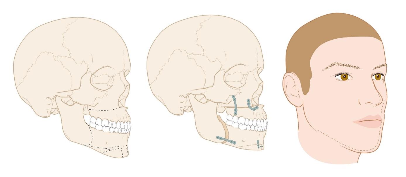 Feminiserende gelaatschirurgie (soorten operaties)