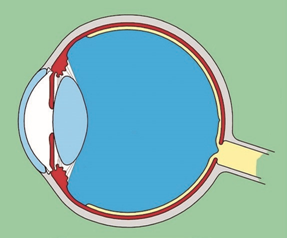 Staar (cataract en staaroperatie bij volwassenen)