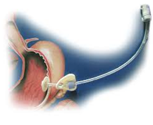 Plaatsing van een PEG-sonde