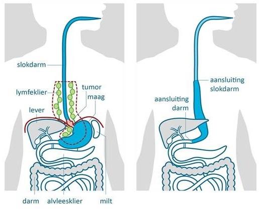 Voedingsadviezen na slokdarmresectie met buismaagreconstructie