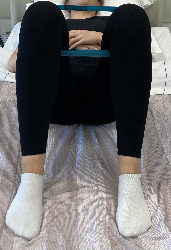 Een gebroken bekken, behandeling met of zonder operatie