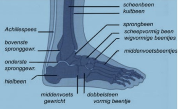 Triple arthrodese