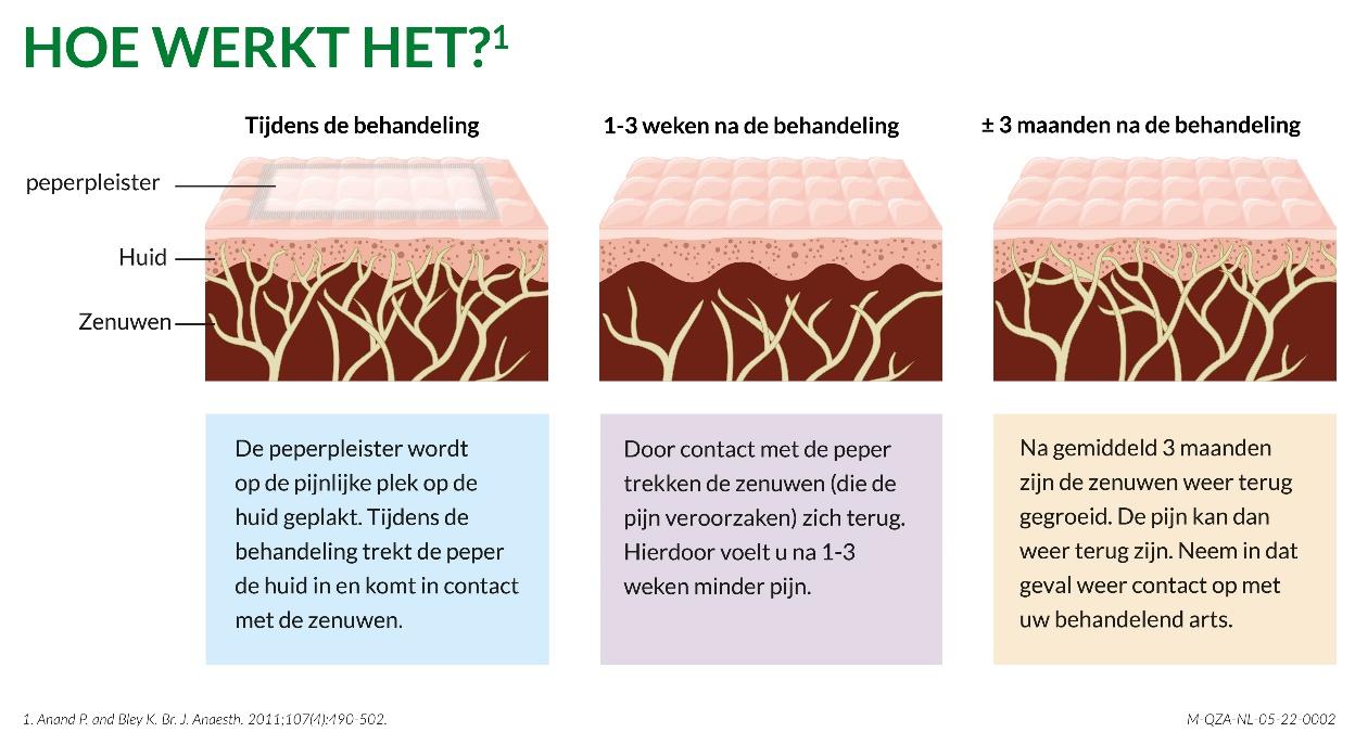 Behandeling met Qutenza-pleister